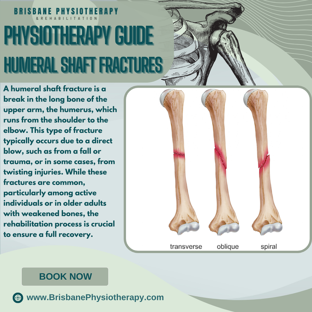Physiotherapy Guide: Humeral Shaft Fractures - Brisbane Physiotherapy ...
