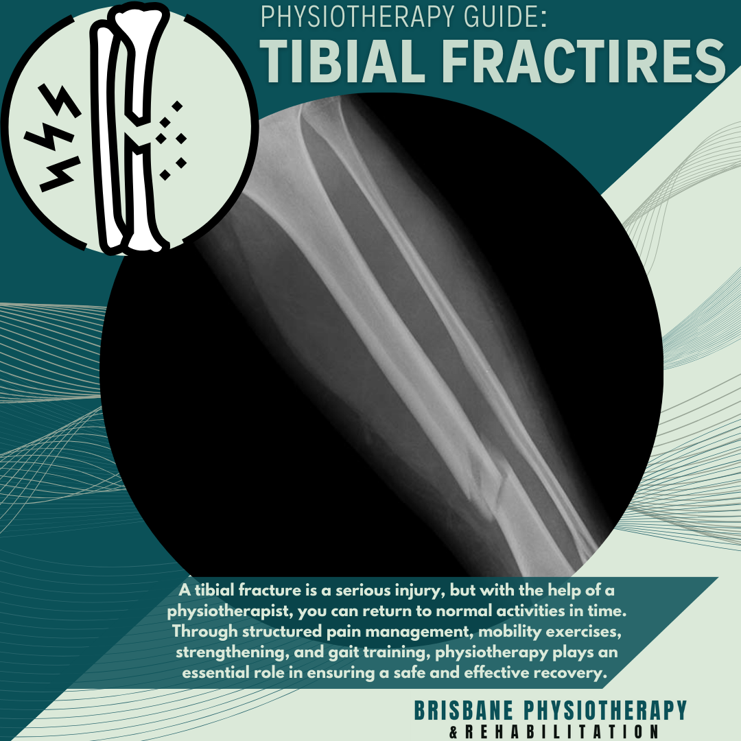 Tibial Fracture: Understanding the Injury and the Role of Physiotherapy ...