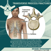 Physiotherapy Guide: Transverse Process Fractures - Brisbane ...