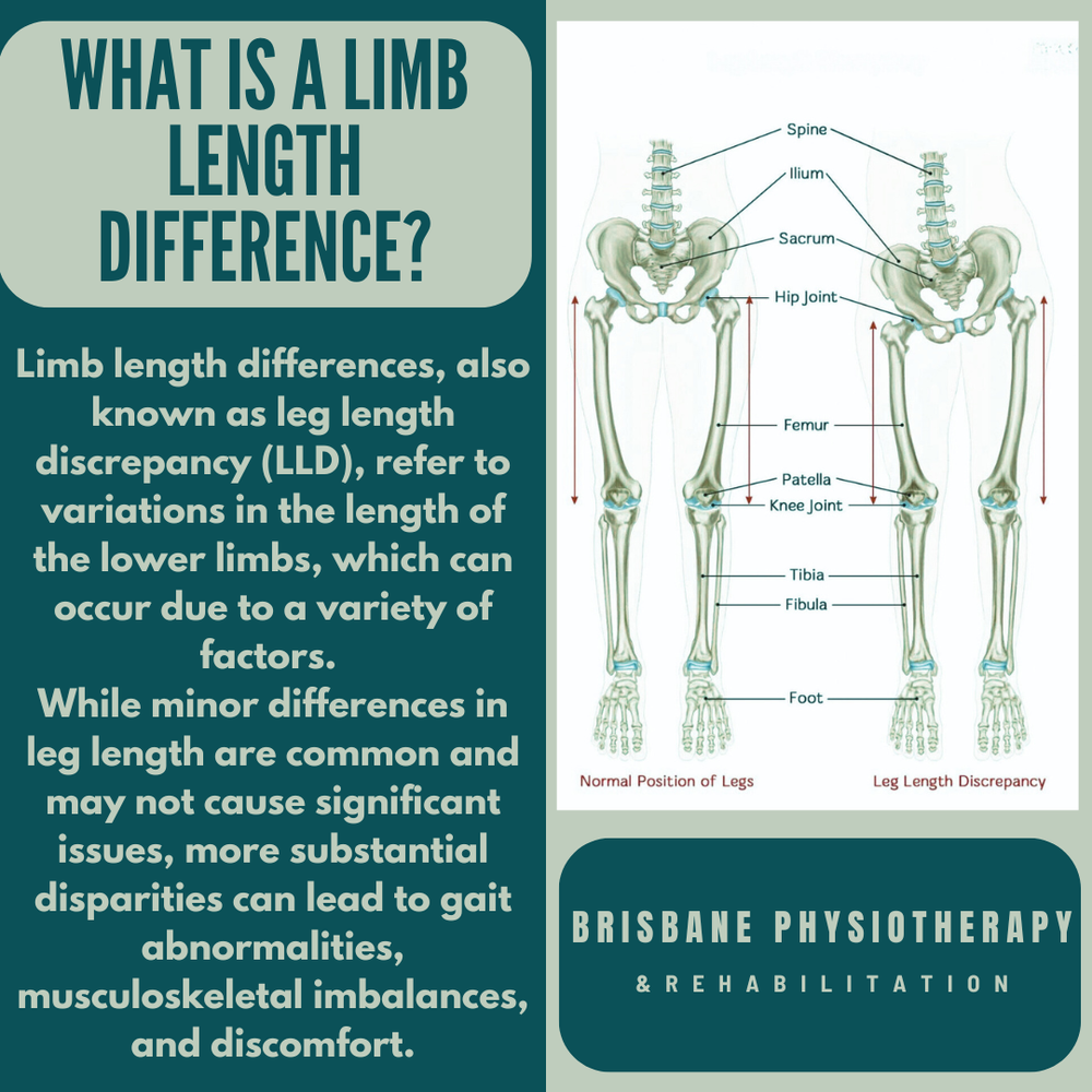 What is a Leg Length Discrepancy? - Brisbane Physiotherapy & Podiatry