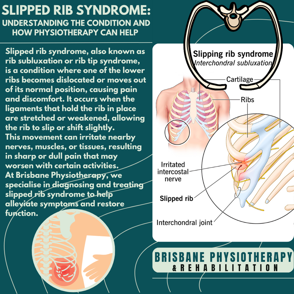 Slipped Rib Syndrome - Brisbane Physiotherapy & Podiatry