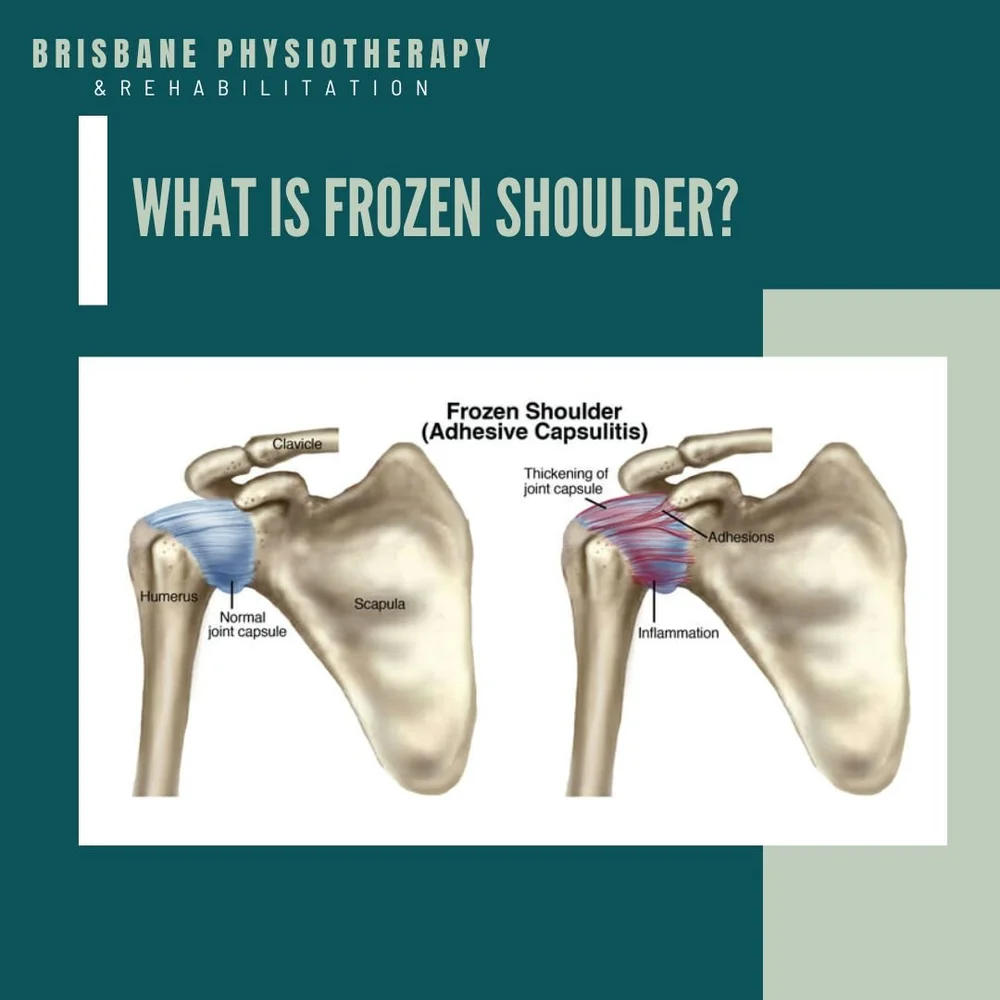 Frozen Shoulder - What is it? Symptoms, Treatment, Physio & Rehab ...