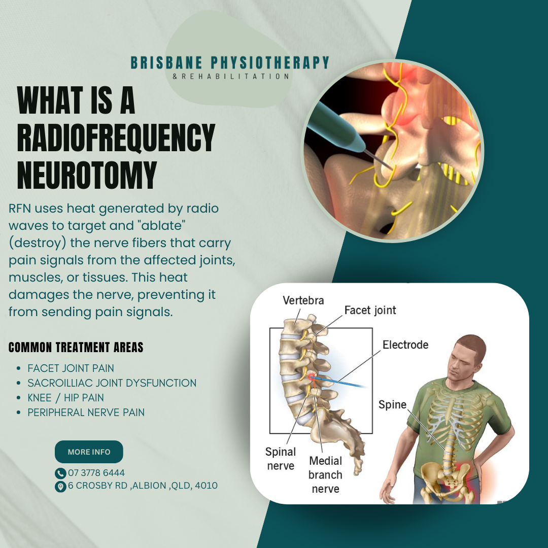 What is Radiofrequency neurotomy? - Brisbane Physiotherapy & Podiatry