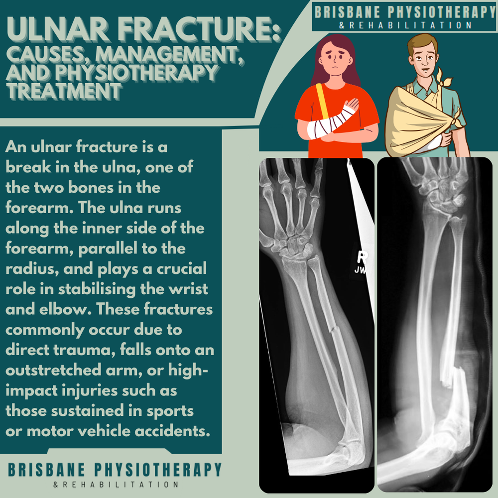 Physiotherapy Guide: Ulnar Fractures - Brisbane Physiotherapy & Podiatry