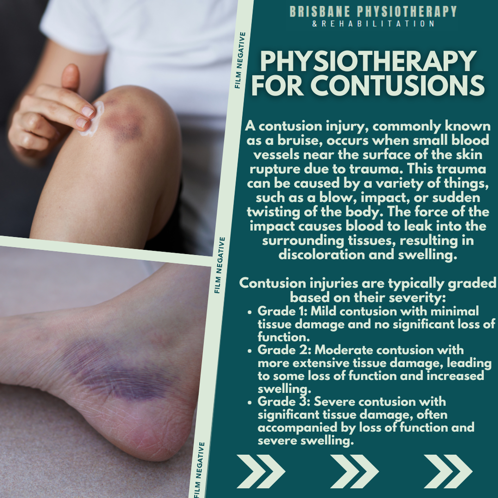 Bruise/Contusion - What are they? Can Physio Help? Should you massage a ...