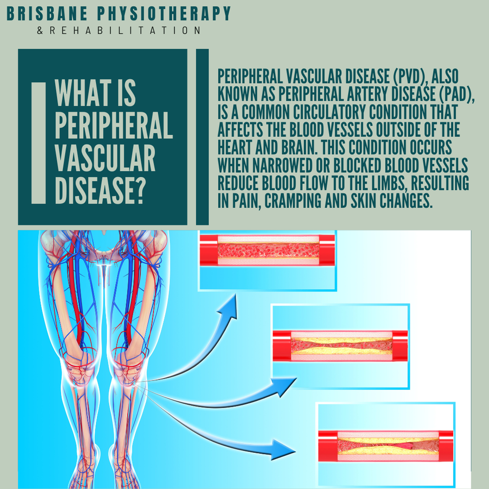 What is Peripheral Vascular Disease? - Brisbane Physiotherapy & Podiatry