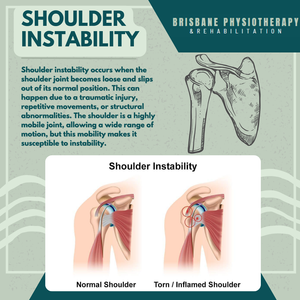 Shoulder Instability: Causes, Symptoms, and Physiotherapy Treatment ...
