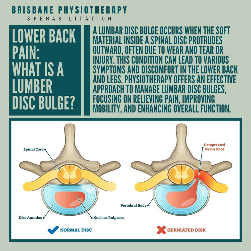 Lower Back Pain - What Is a Lumbar Disc Bulge - Brisbane Physiotherapy ...