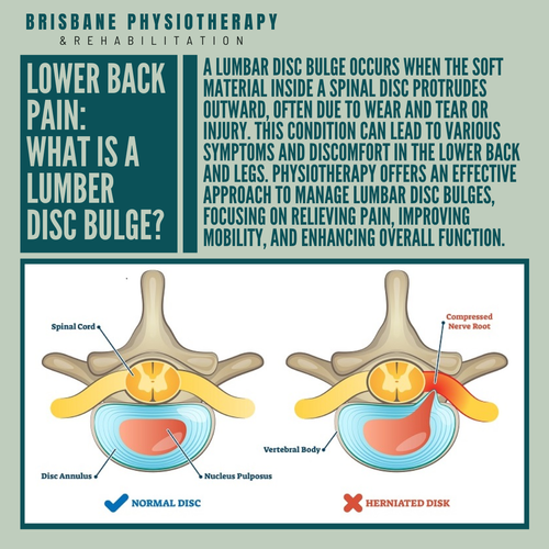 Lower Back Pain - What Is a Lumbar Disc Bulge - Brisbane Physiotherapy & Podiatry