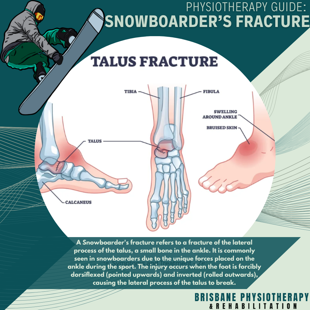 Snowboarder's Fracture: Causes, Symptoms, and Physiotherapy Treatment ...