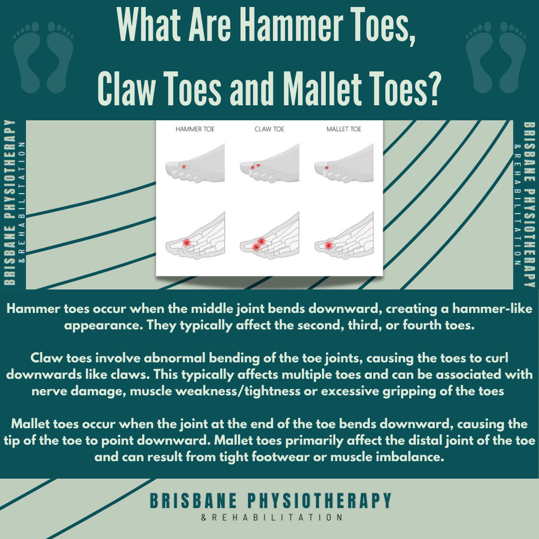 What Are Hammer Toes, Claw Toes, and Mallet Toes - Brisbane ...