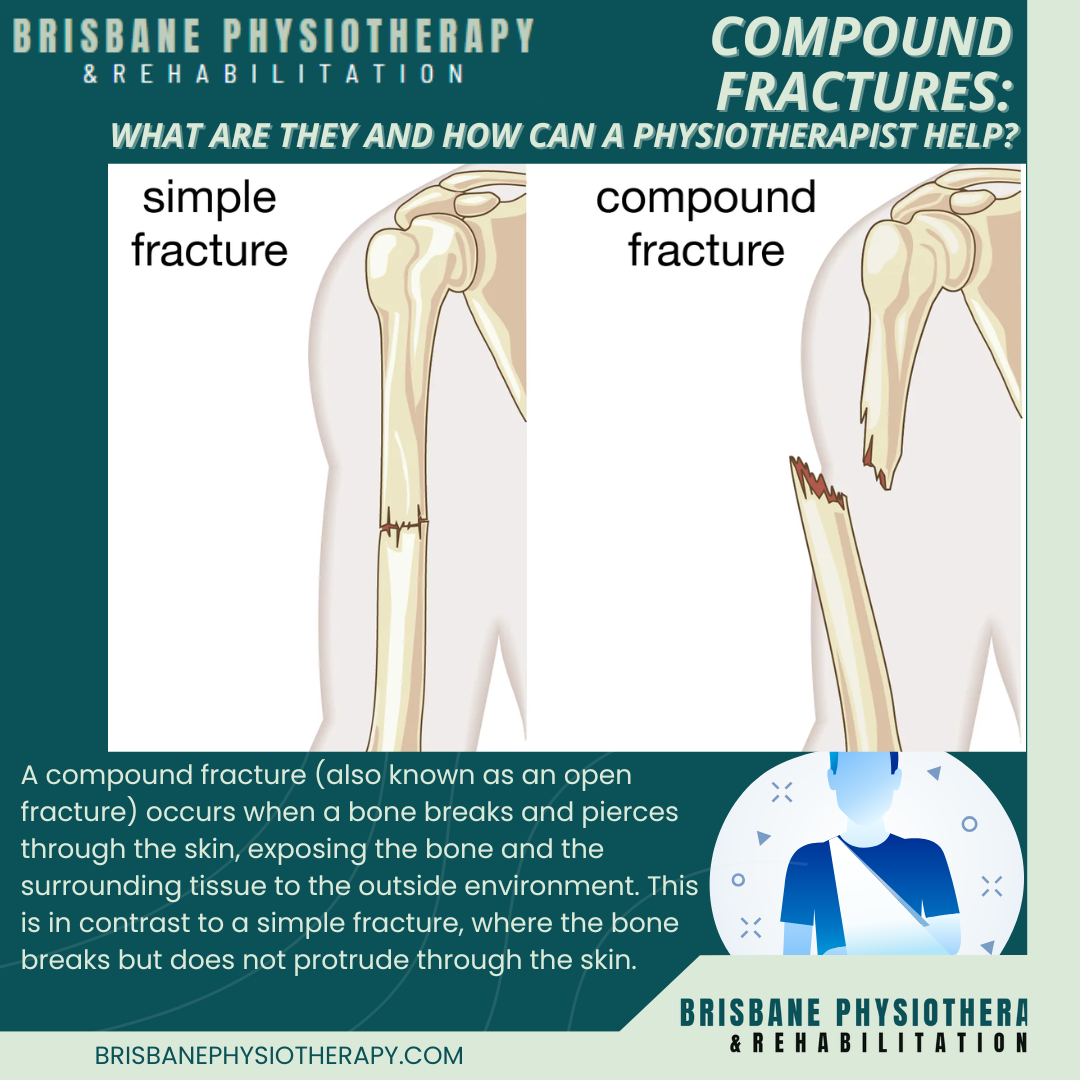 Compound Fractures and How Physiotherapy Can Help - Brisbane ...