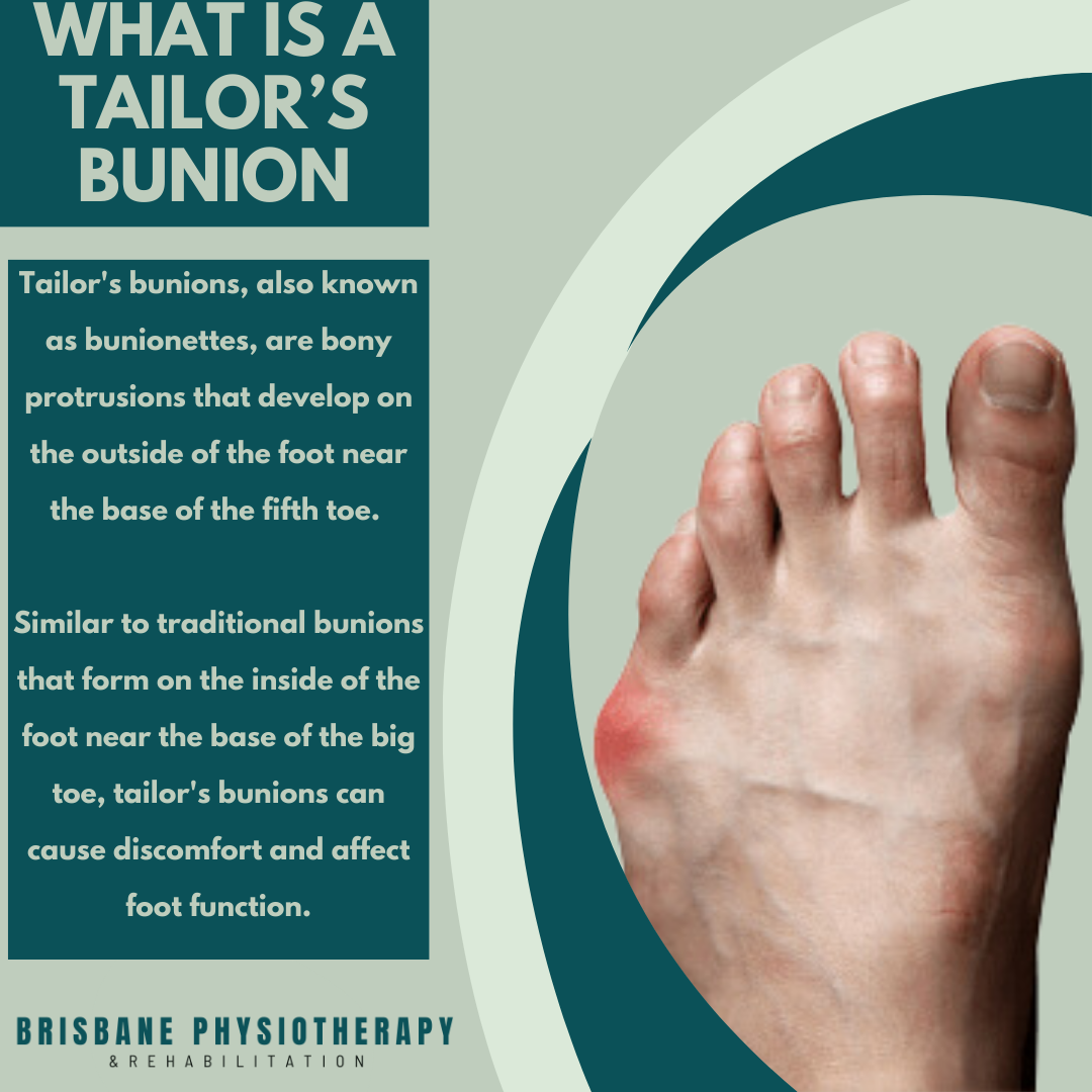What Is a Tailor's Bunion (Bunionette)? - Brisbane Physiotherapy & Podiatry