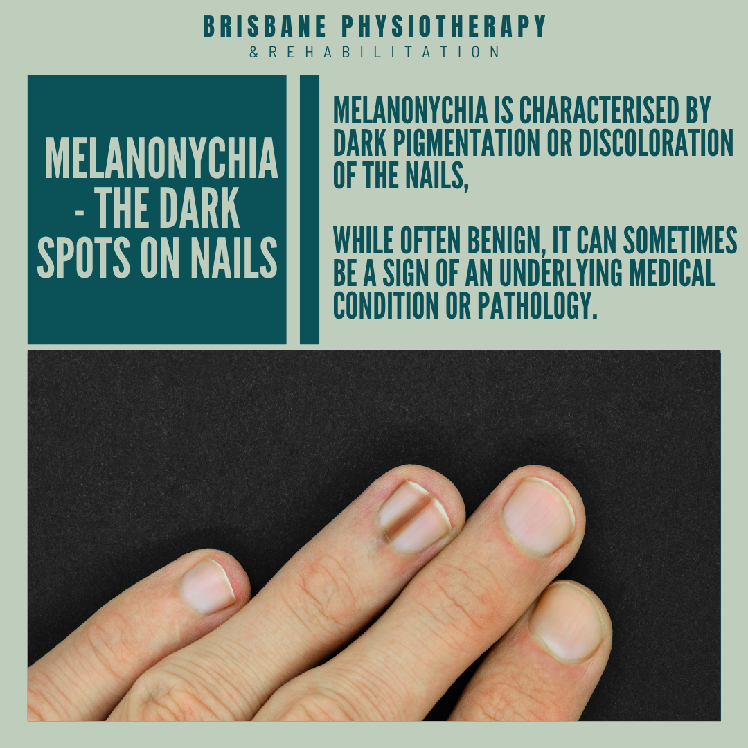 Dark Spots on Nails – What Is Melanonychia - Brisbane Physiotherapy ...
