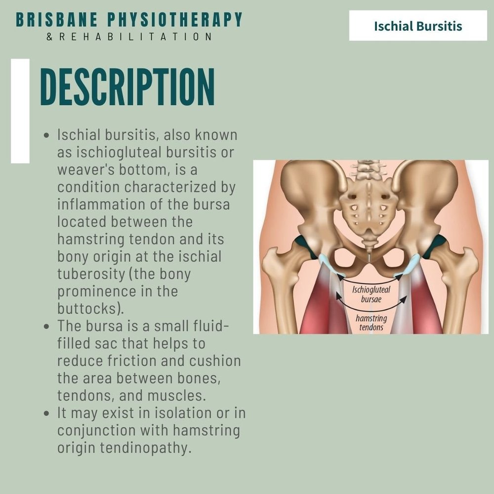 Ischial Bursitis - What is it? Symptoms, Treatment & Physio - Brisbane Physiotherapy & Podiatry
