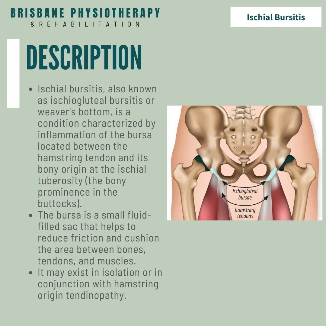 Ischial Bursitis - What is it? Symptoms, Treatment & Physio - Brisbane Physiotherapy & Podiatry