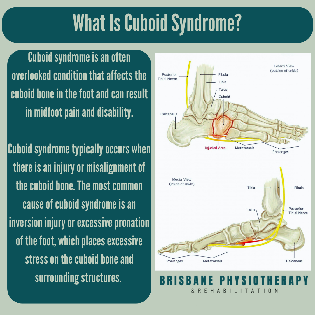 What is Cuboid Syndrome? - Brisbane Physiotherapy & Podiatry