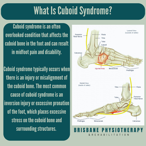 What is Cuboid Syndrome? - Brisbane Physiotherapy