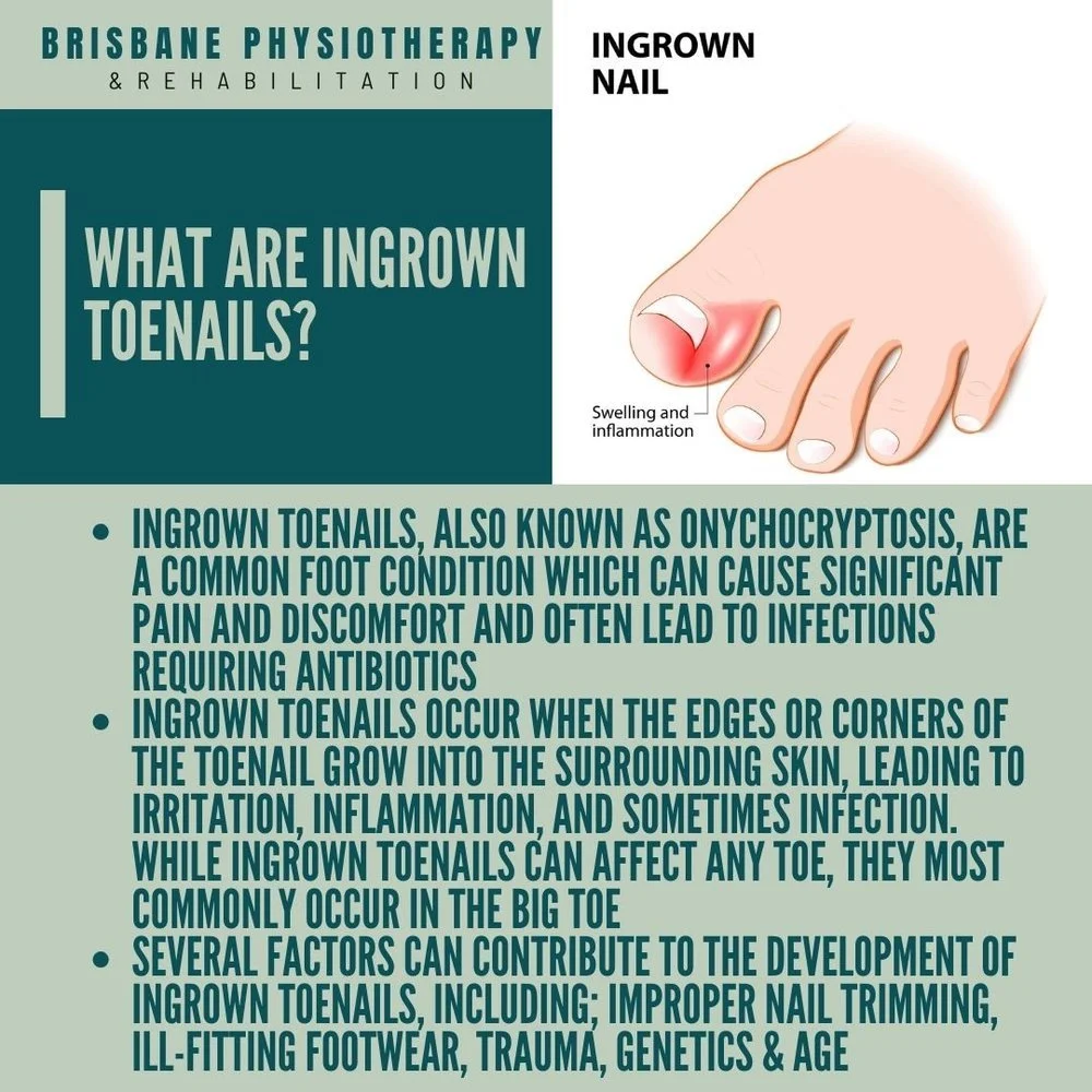 Ingrown Toenail Treatment in Brisbane - Brisbane Physiotherapy & Podiatry