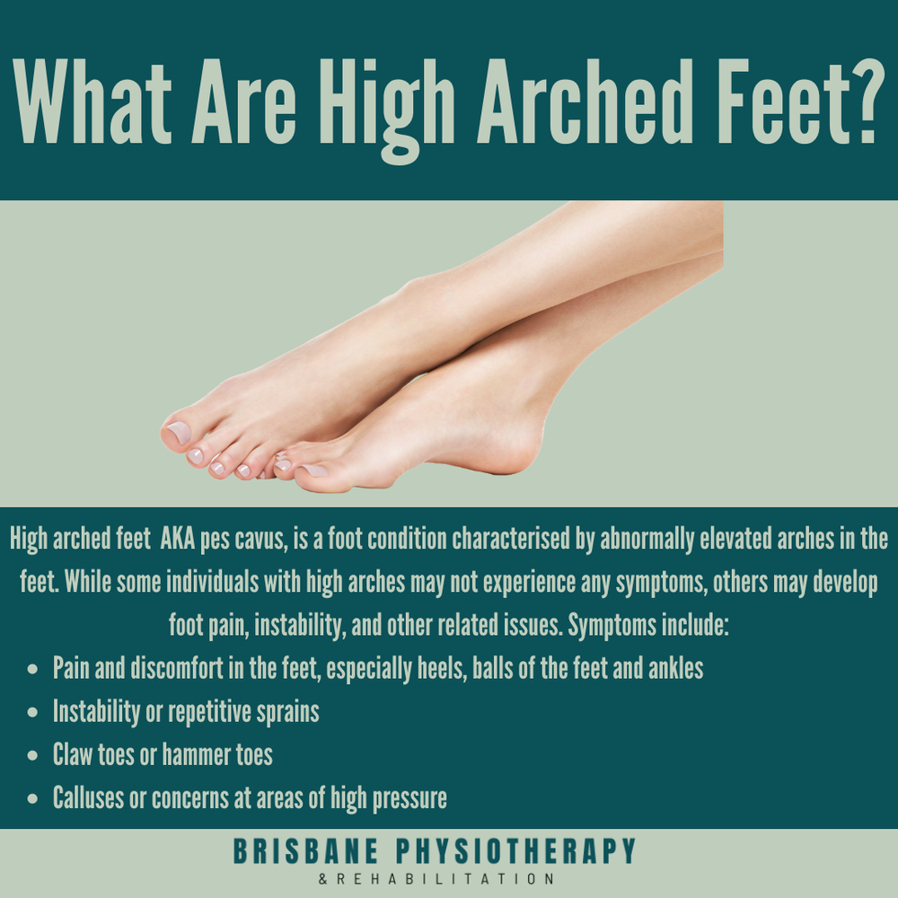 High Arch Feet - Causes, Symptoms & Treatment - Brisbane Physiotherapy & Podiatry