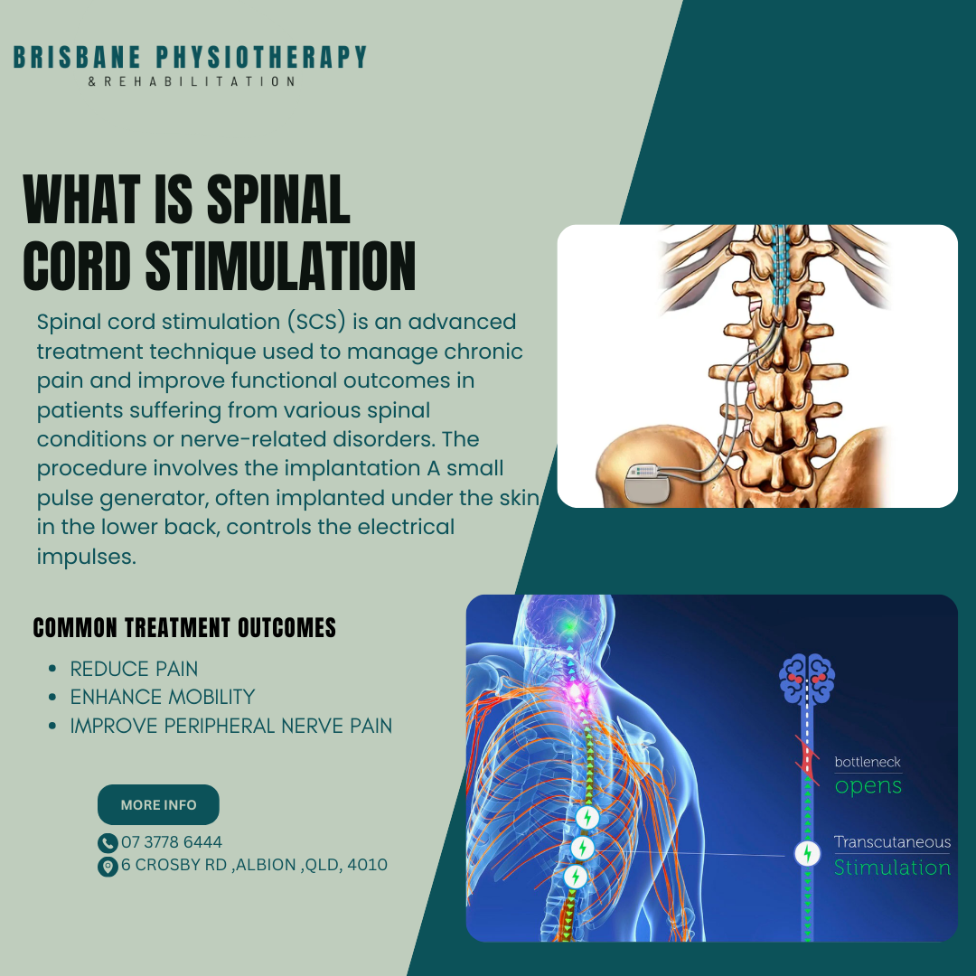 What is Spinal Cord Stimulation - Brisbane Physiotherapy & Podiatry