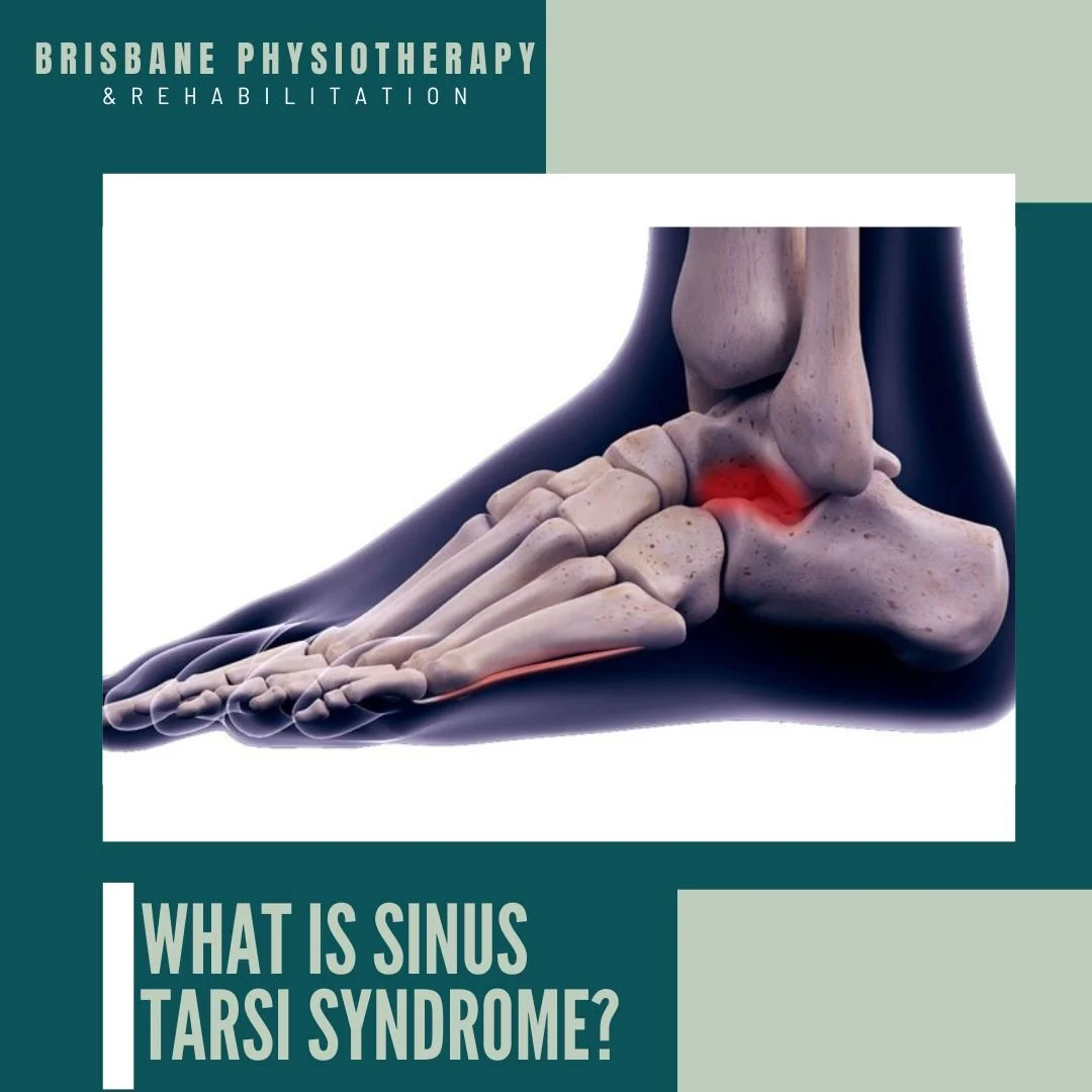 What is Sinus Tarsi Syndrome? - Brisbane Physiotherapy & Podiatry