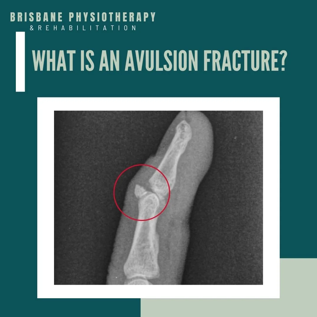 Avulsion Fractures - What are they? Symptoms, Diagnosis, Treatment, Physio & Rehab - Brisbane ...