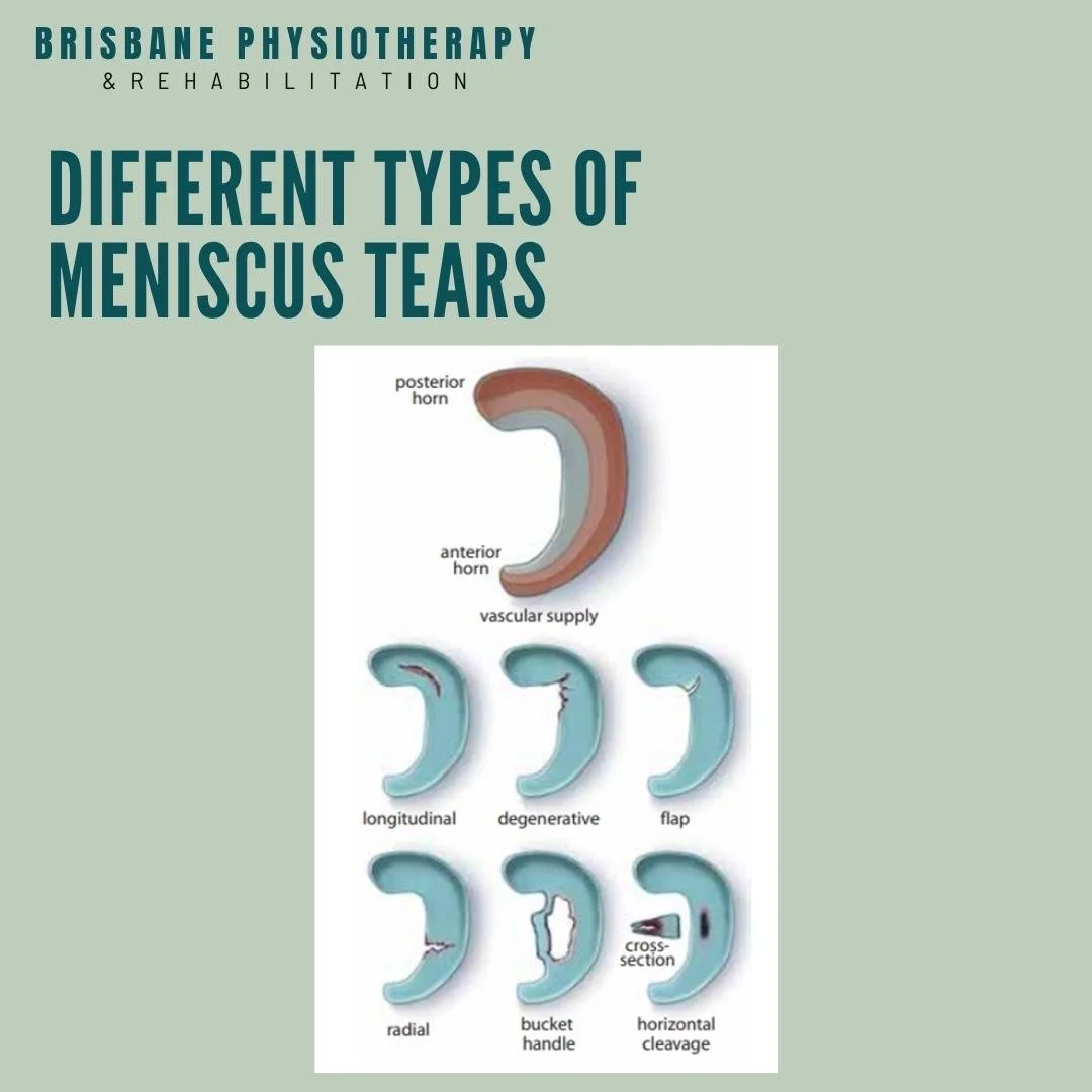 Meniscus Tear/Injury - What is it? Symptoms, Treatment, Rehab & Physio ...
