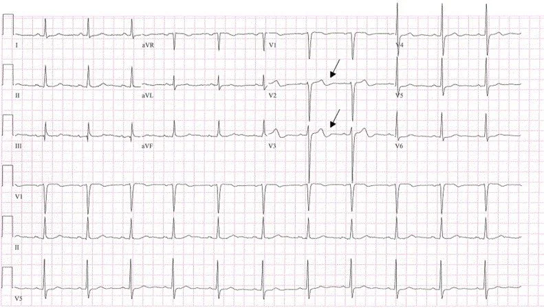 Potassium & The Heart: Hypo/Hyperkalemia — EMS.Aware