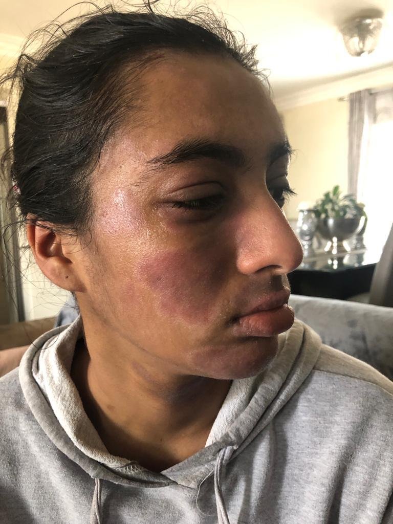 Understanding Atopic Dermatitis in Skin of Color — The Itch Podcast