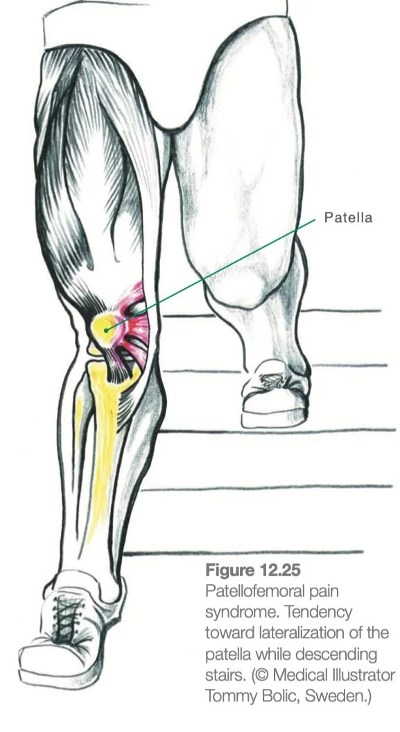 Physiologic - What you need to know about Patellofemoral (Knee) Pain