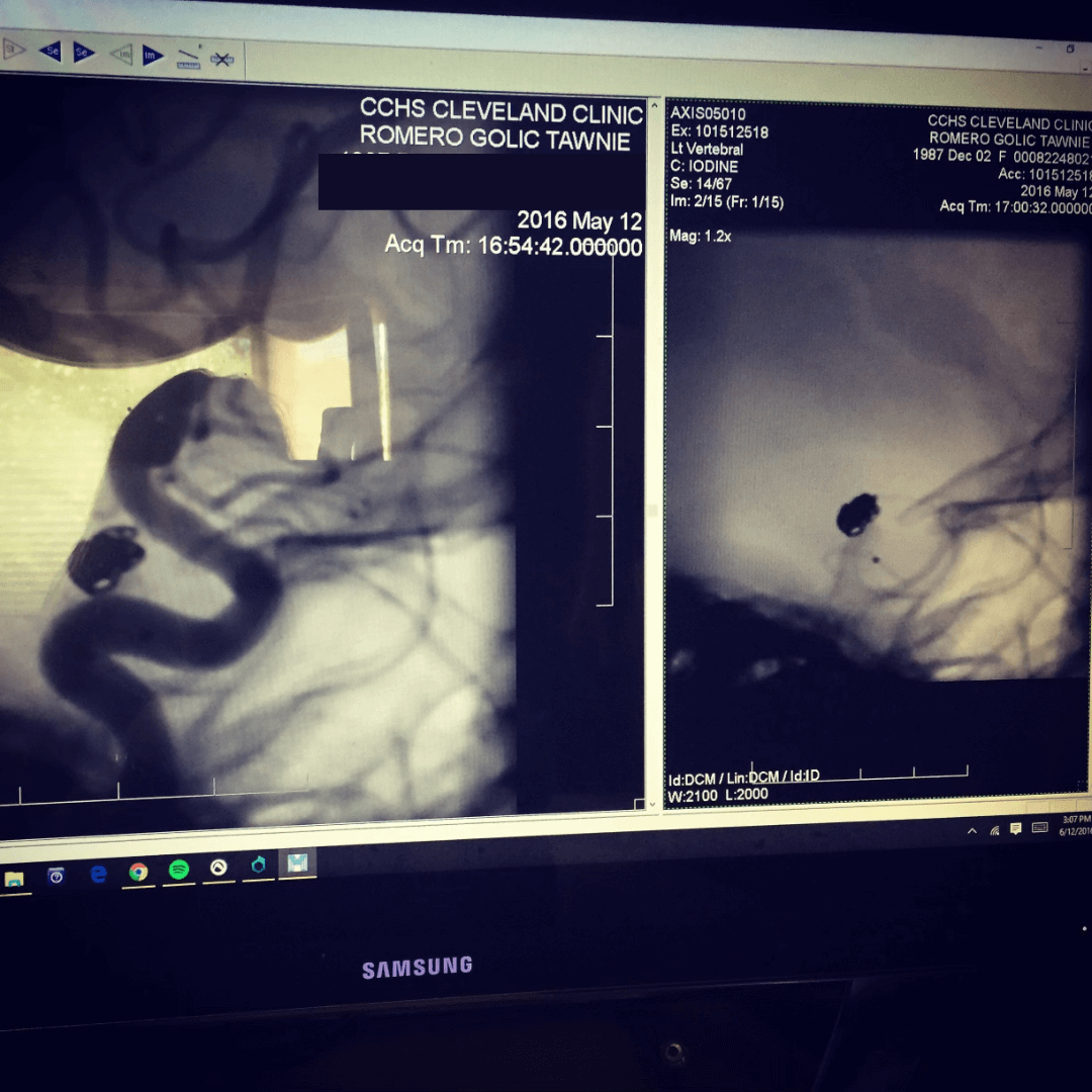 Dive Into the Mind of an Aneurysm Survivor: The TBI MedSLP Webinar That’s Redefining Patient ...