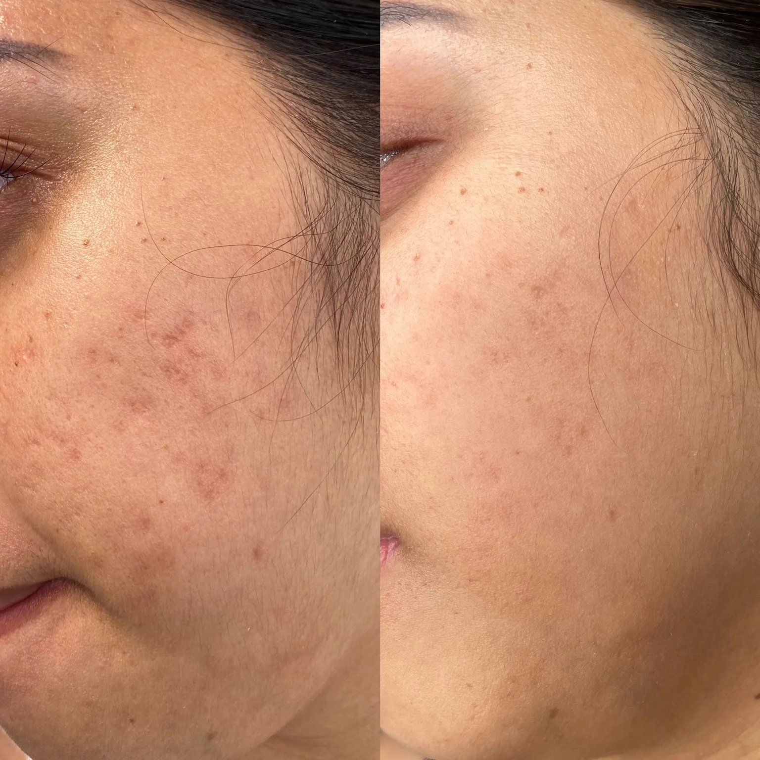 micro-needling — Orange County Lip Blush
