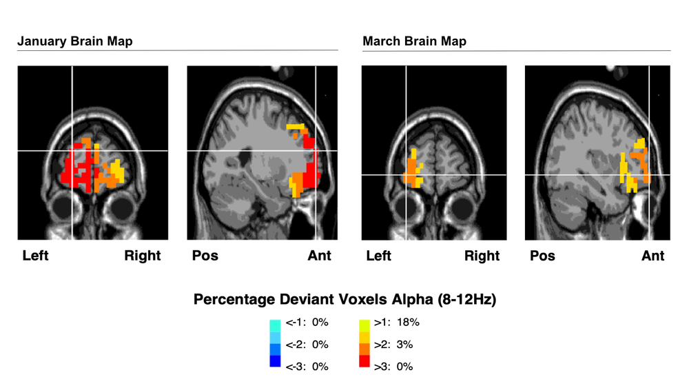 Neurofeedback & Brain Mapping — Aspire Counseling Network
