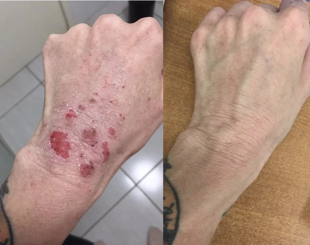 Topical Steroid Withdrawals — The Functional Skin Studio