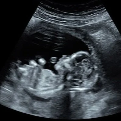 General 2 — Sneak Peek Ultrasounds