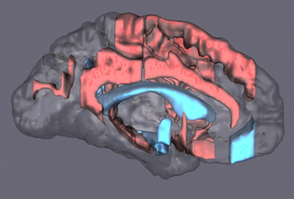 Sex Differences in the Healthy Brain — CNL-SD