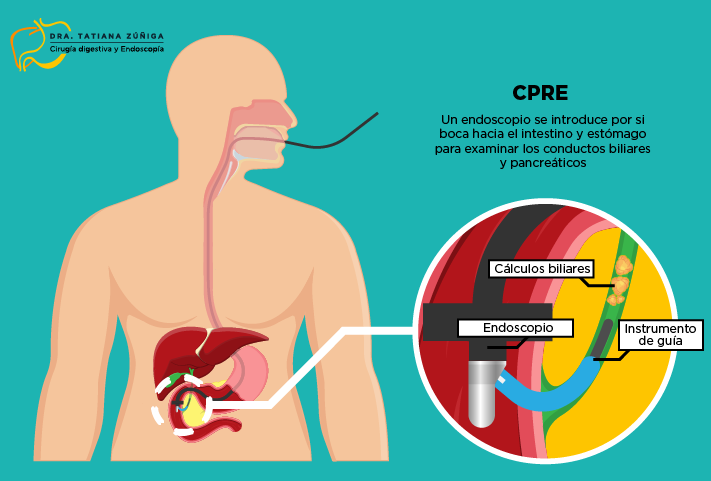 Colangiopancreatografía Retrógrada Endoscópica