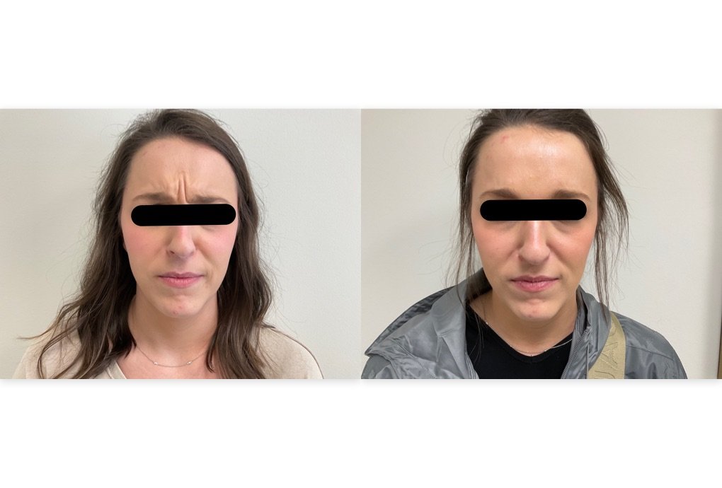 Botox Newnan GA | Botox Peachtree City — Carroll Cosmetic Club