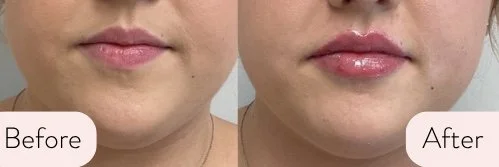 Botox Newnan GA | Botox Peachtree City