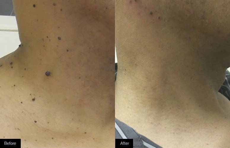 Mole, DPN, and Skin Tag Removal — Ingleton Dermatology P.C.