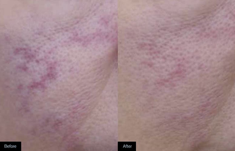 Broken Blood Vessel Treatment — Ingleton Dermatology P.C.