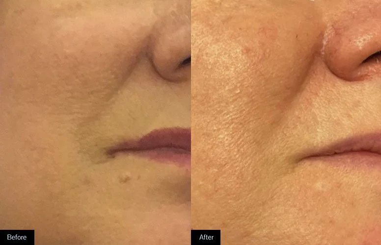 Mole, DPN, and Skin Tag Removal — Ingleton Dermatology P.C.