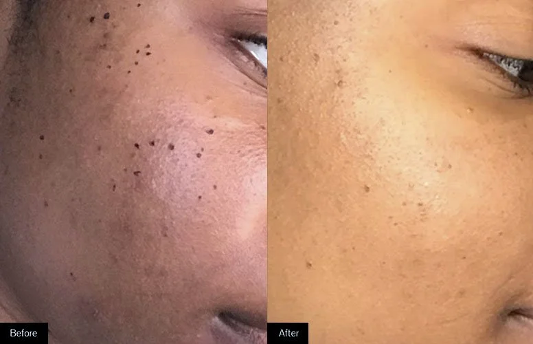 Mole, DPN, and Skin Tag Removal — Ingleton Dermatology P.C.