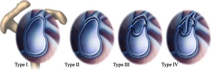 SLAP Tears Treatment | 417 Performance Chiropractic Springfield, MO