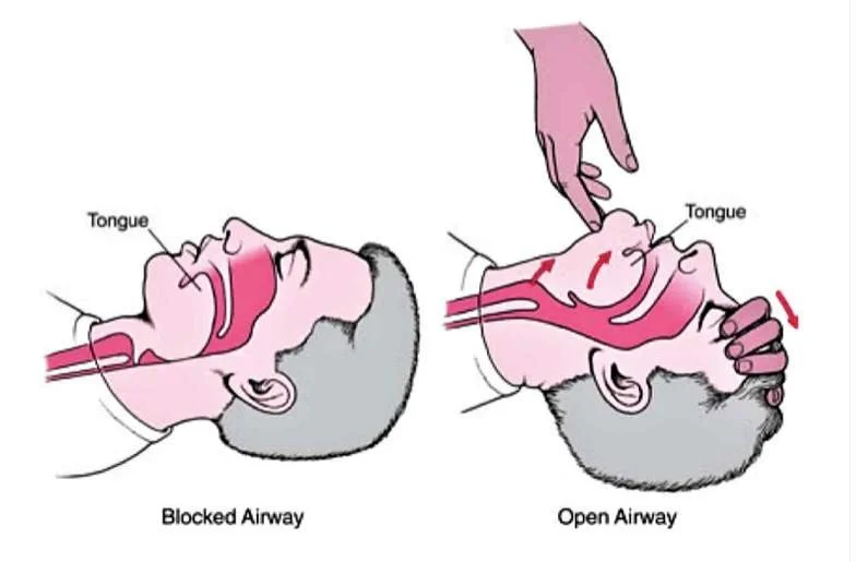 Airway Opening Manoeuvres — iRescue