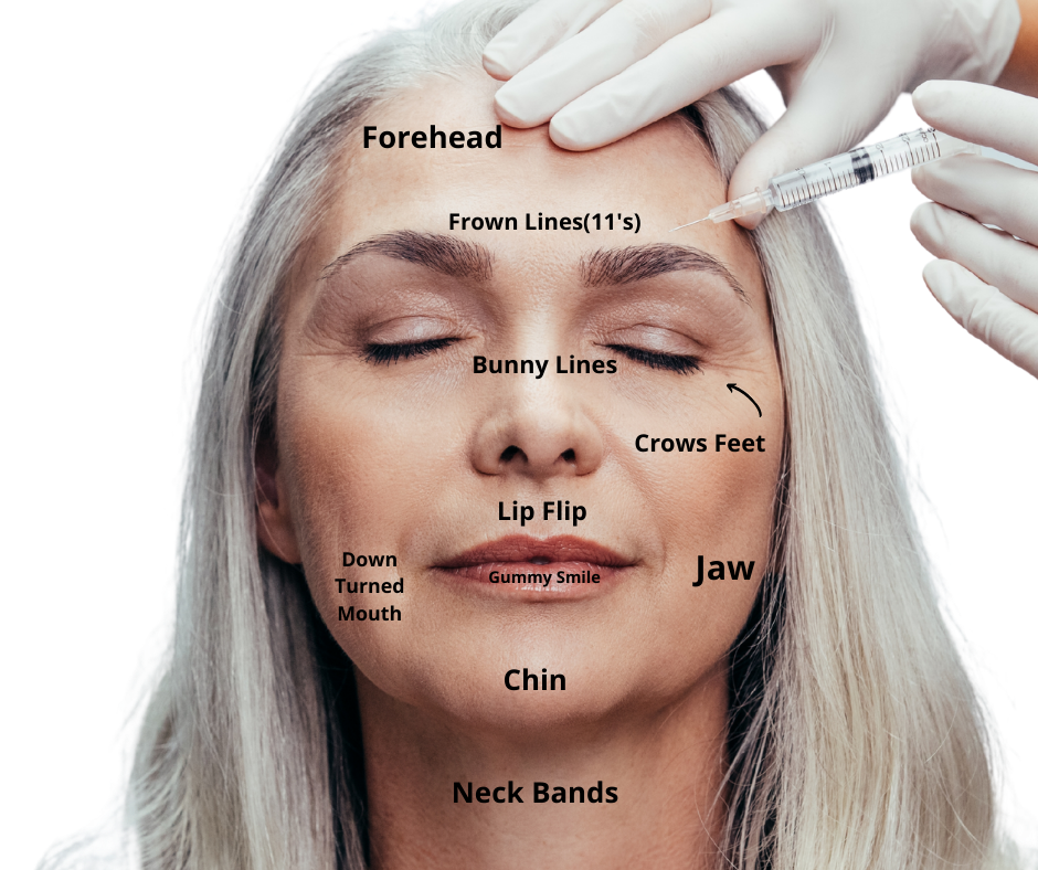 Wrinkle Relaxers "Botox" — Modern Edge Aesthetics