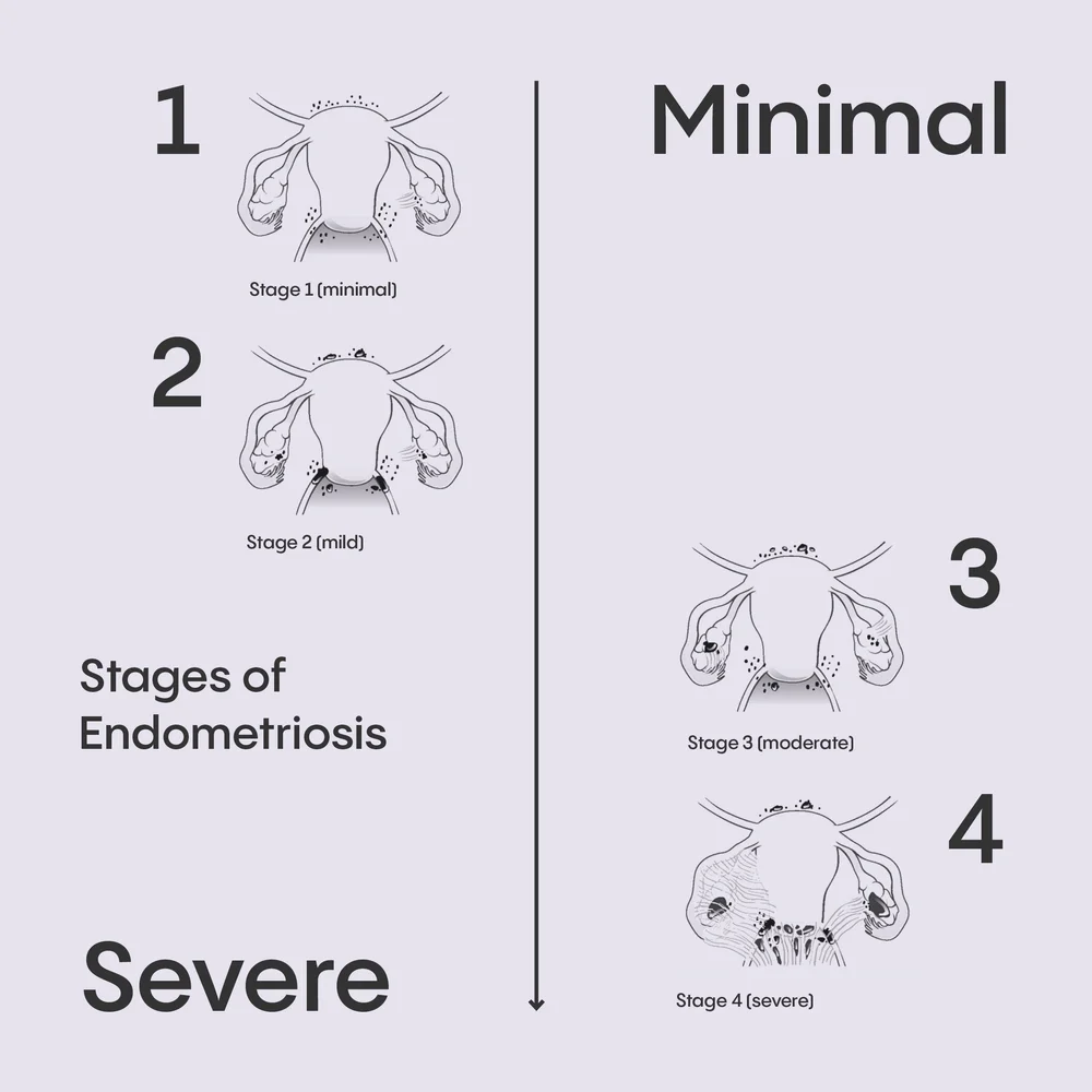 Endometriosis — Dr. Praveen De Silva - Gynaecologist