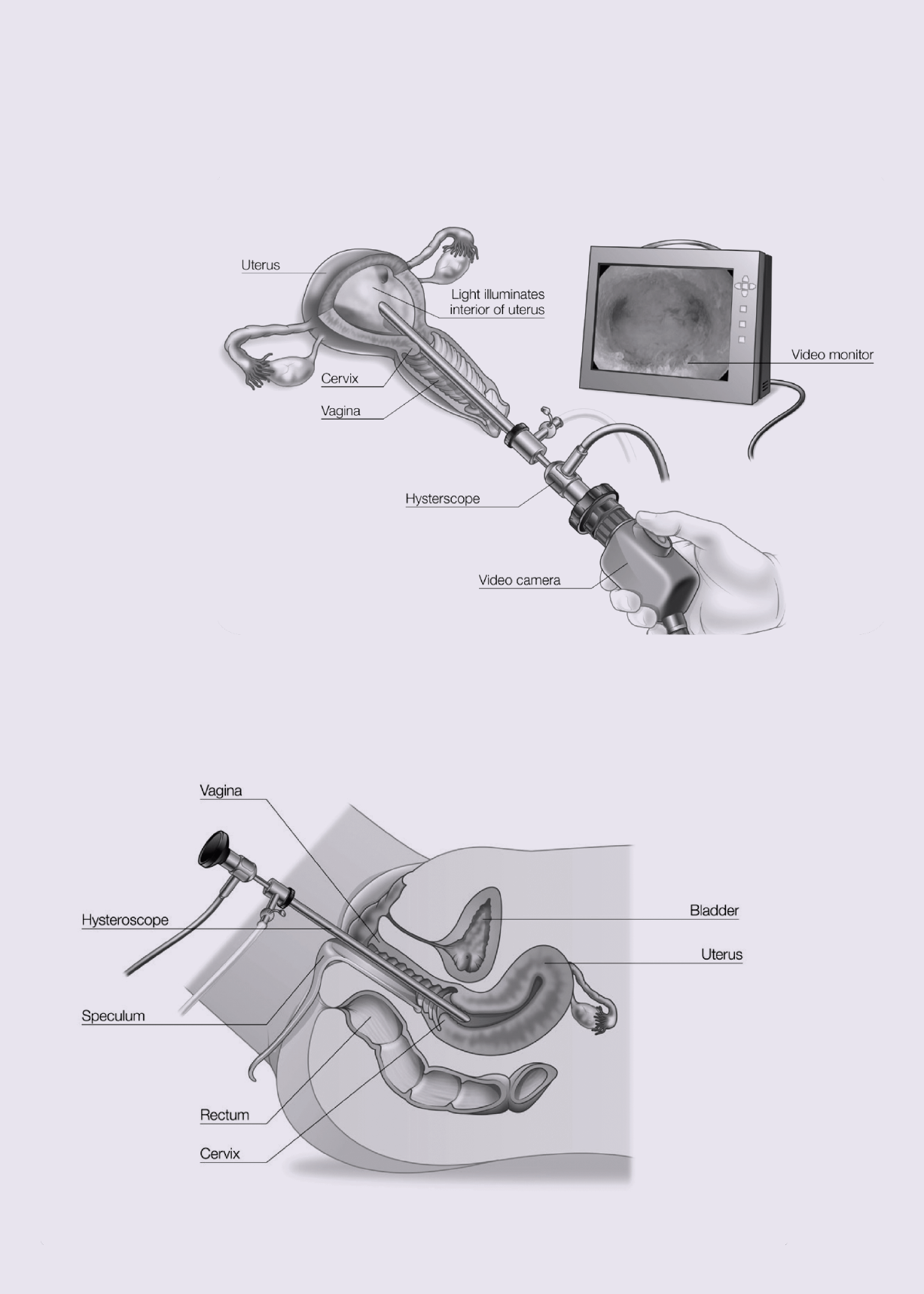 Hysteroscopy — Dr. Praveen De Silva - Gynaecologist