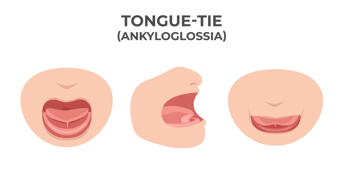 Tongue ties & speech development — Toddler Talk